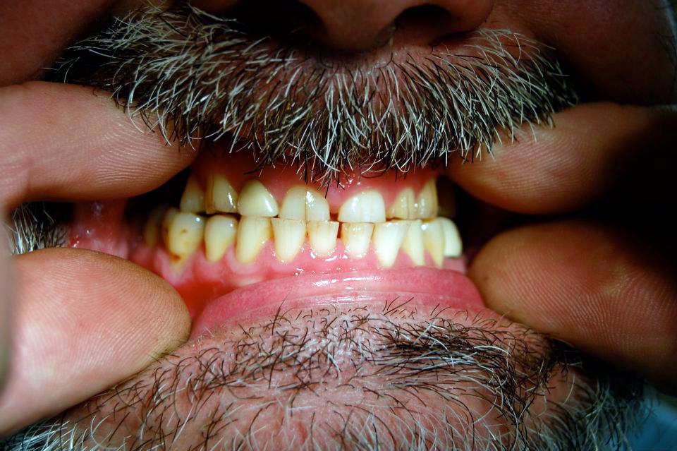 Smile Rehabilitation - Riverside Dental Practice, Braunton, North Devon